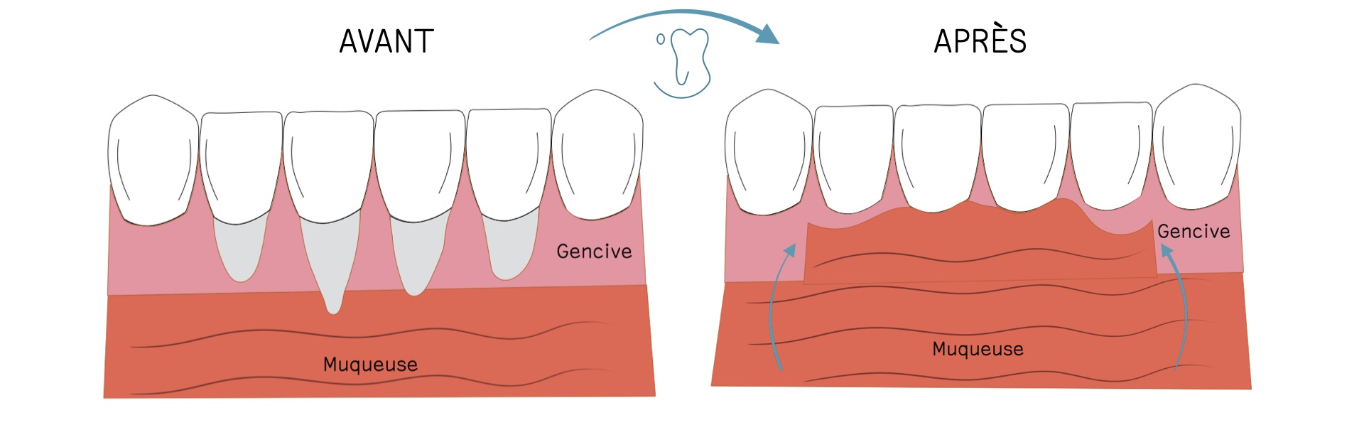 La greffe de gencive : explications et cas cliniques - Parodysseum